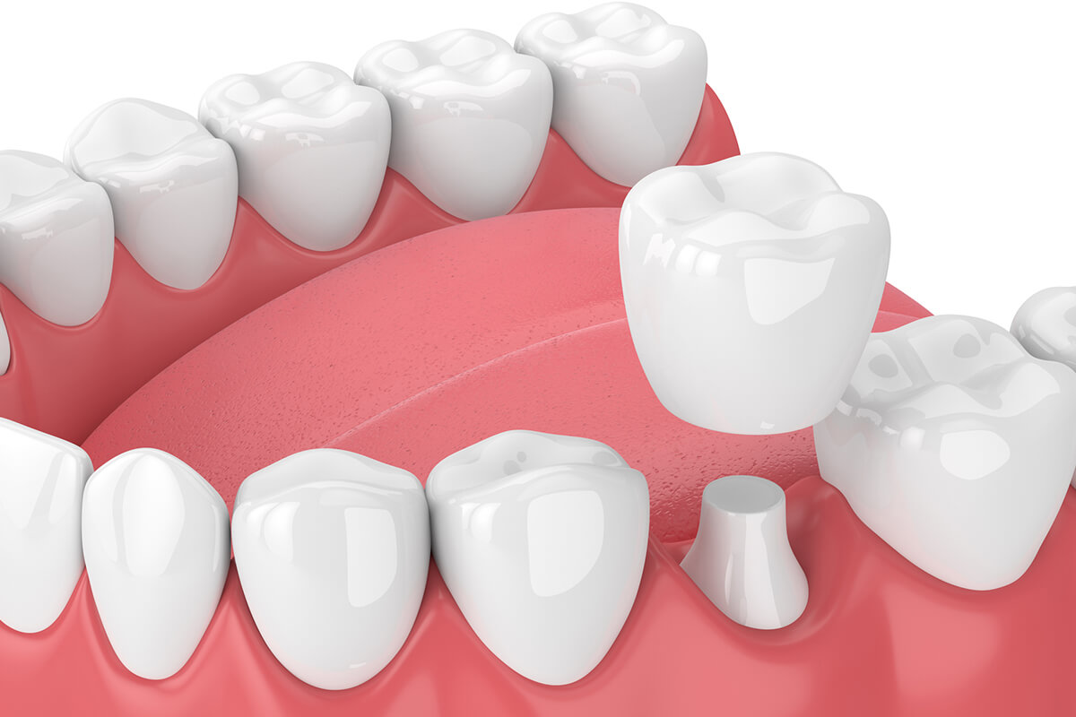 What If There Is Not Enough Tooth For A Crown? - Dental Care of Brunswick